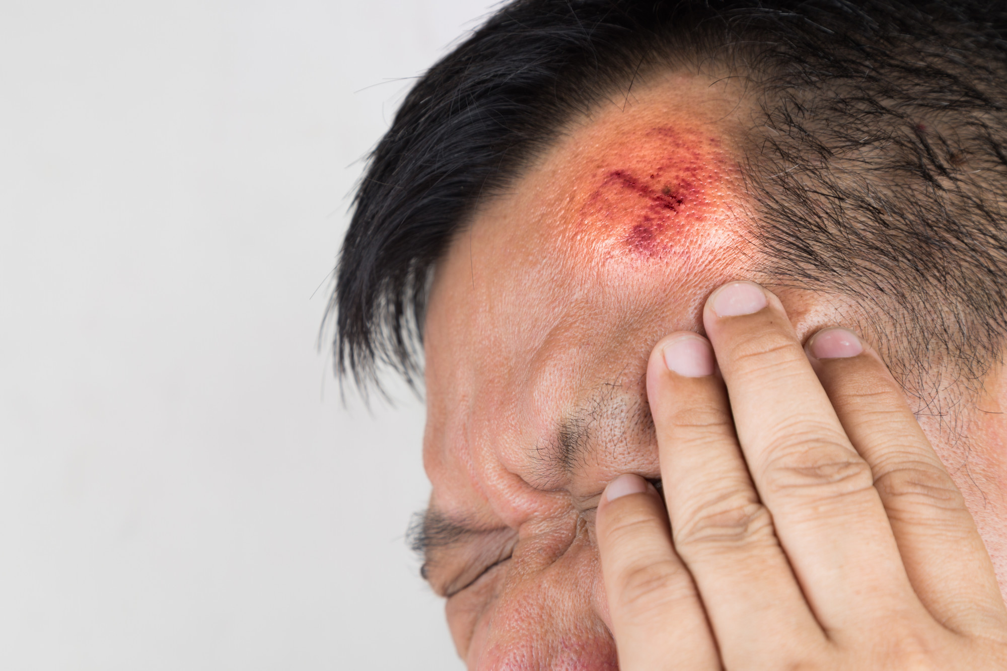 I Hit My Head How Do I Know If It s Serious A Head Injury Guide I Hit My Head How Do I Know If It s Serious A Head Injury Guide